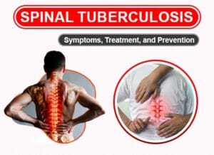 Spinal Tuberculosis: Causes, Symptoms, Diagnosis & Treatment | Mukat ...